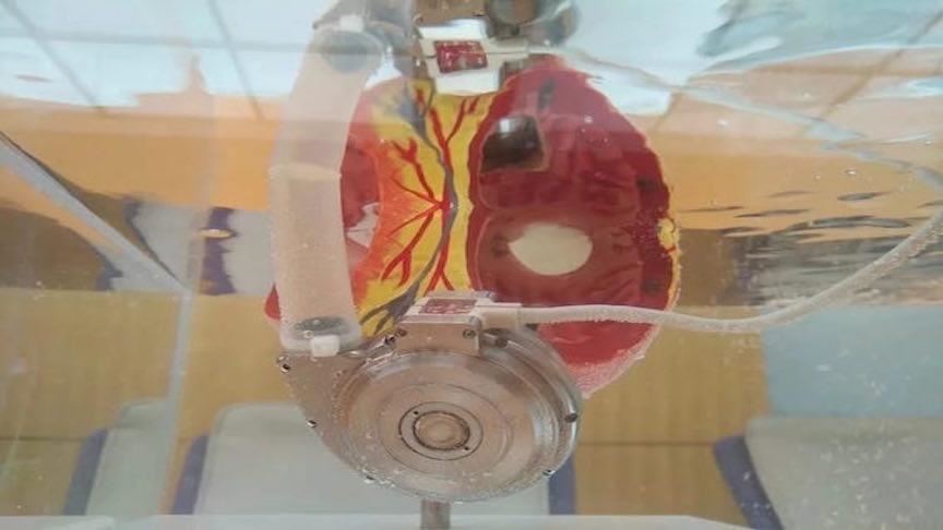 China’s indigenous 'artificial heart' saves two