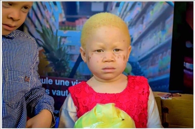 À Kinshasa, le monde associatif au secours des albinos - Anadolu Ajansı